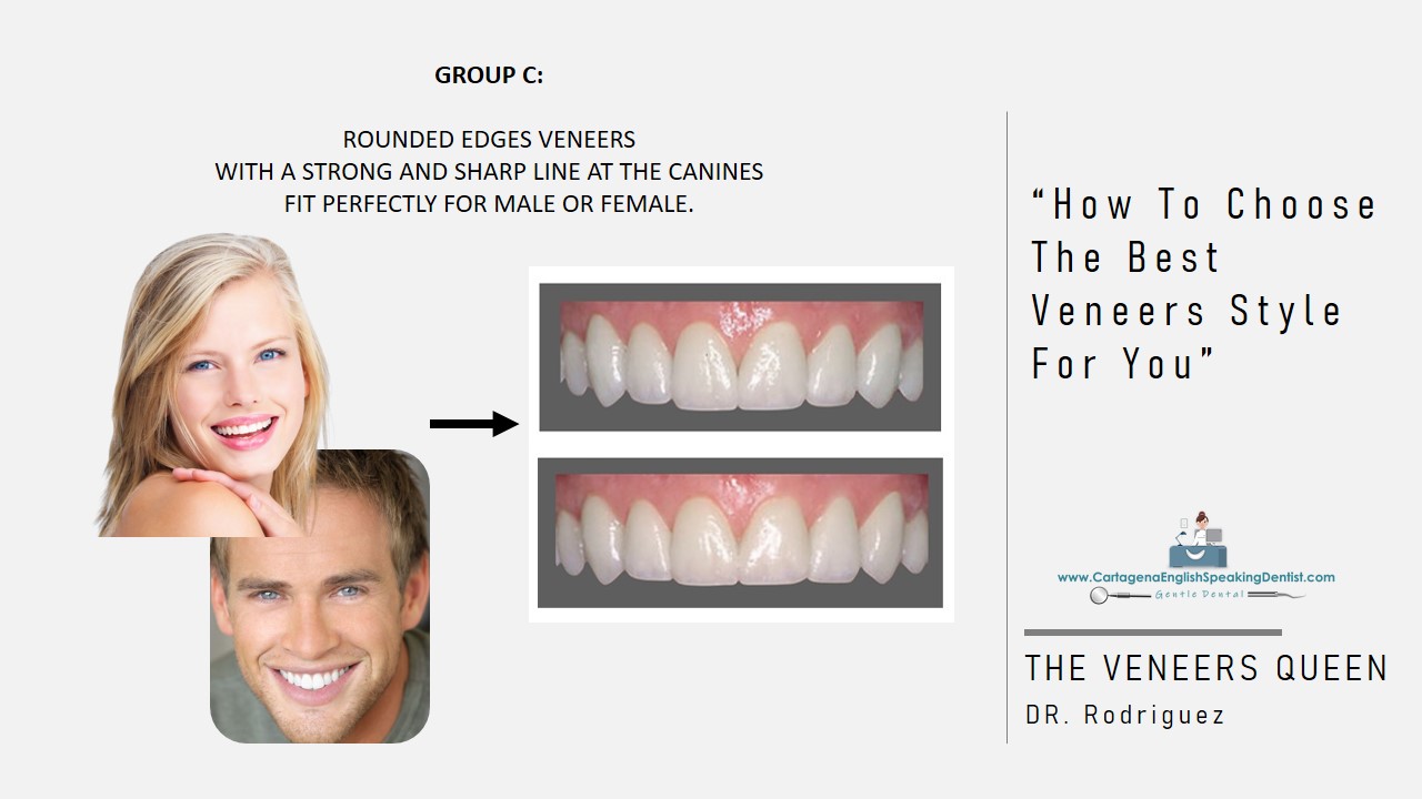 CHOOSING THE RIGHT SHAPE VENEERS ⋆ Cartagena English