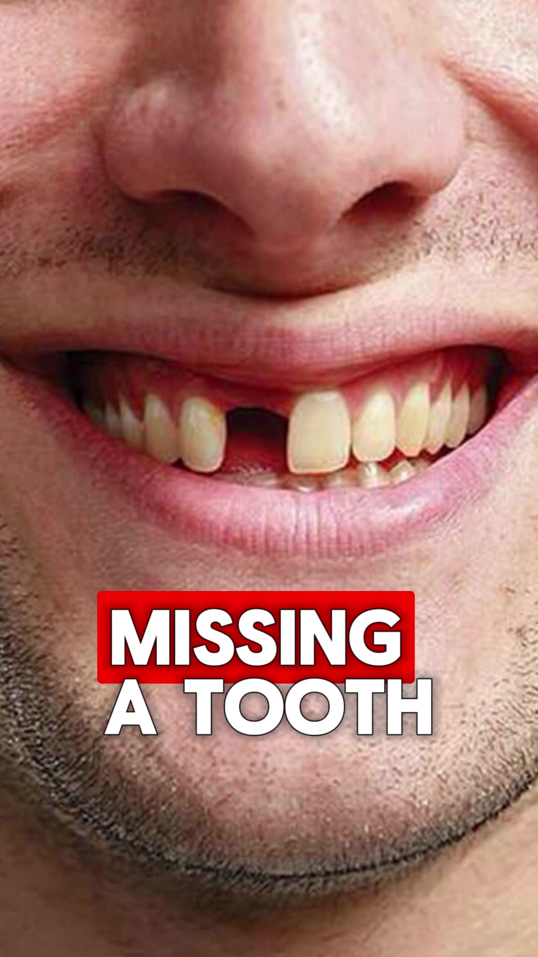 REPLACE A MISSING TOOTH WITH DENTAL BRIDGES